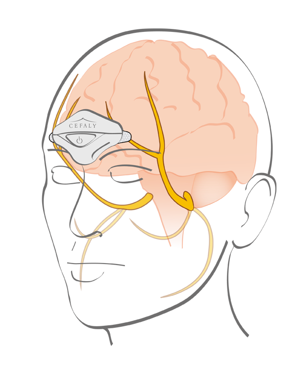 Cefaly Migraine Relief Device